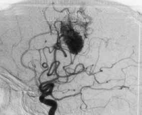 Radiosurgery for AVM