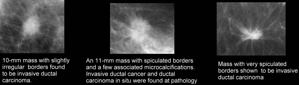 Basic Information about Mammograms