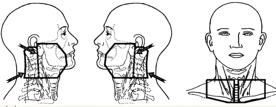 Simulation for Head and Neck Cancer